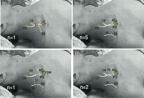 Schematic Representation Of Brachial Plexus Reconstruction In 9 Download Scientific Diagram