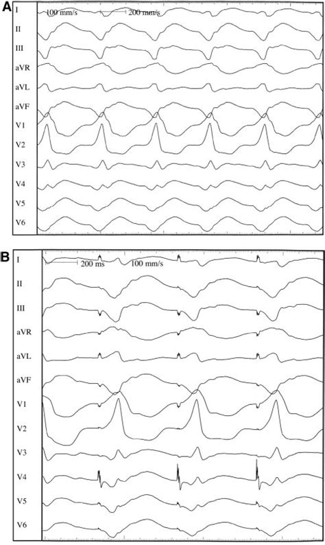 A Surface 12 Lead Ecg Of Normal Heart Vt B Epicardial Pace Map At Download Scientific