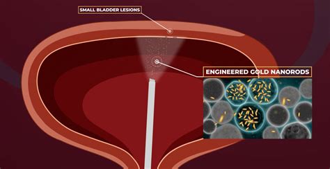Gold Nanoparticles San Raffaeles Research Opens New Frontiers In