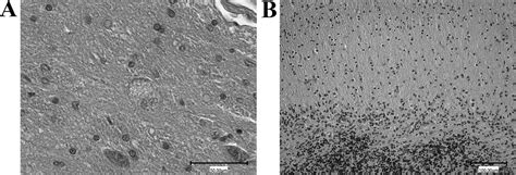 An Autopsy Case Of Microencephaly Bizarre Putaminal Lesion And