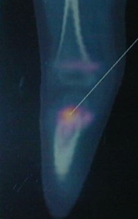 Sarcoma De Ewing Da Tíbia Oncocirurgia