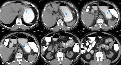 Plain Ct Showing Extensive Diffuse Mucosal Fold Thickening