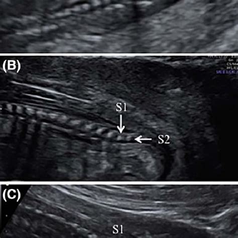 Pdf How To Explore Fetal Sacral Agenesis Without Open Dysraphism Key Prenatal Imaging And