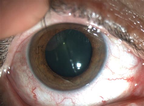 A Anterior Segment Picture Of The Right Eye Depicting Normal