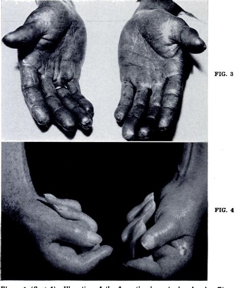 Figure 3 From The Pulmonary Manifestations Of Generalised Scleroderma Progressive Systemic