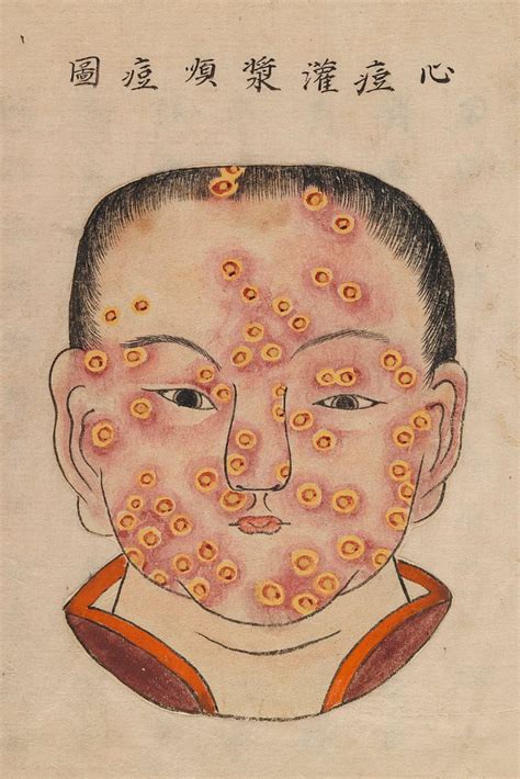 Smallpox Illustration Japanese Manuscript Ca 1720 Vintage News Daily