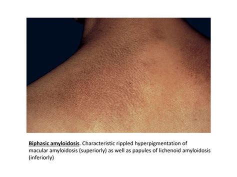 Cutaneous Amyloidosis By Dermatology Residentpptx Blood Disorders