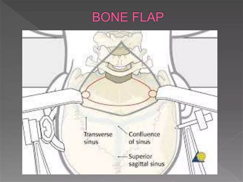 Decompressive Craniectomy Pptx
