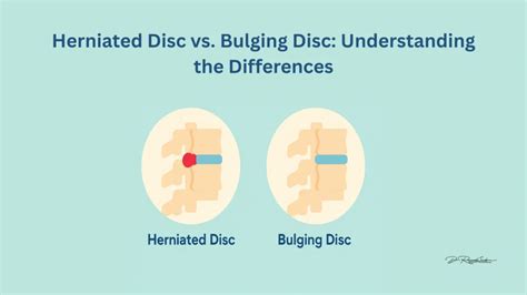 Herniated Disc Vs Bulging Disc Understanding The Difference