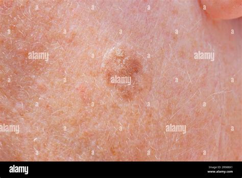 Mole Examination Hi Res Stock Photography And Images Alamy