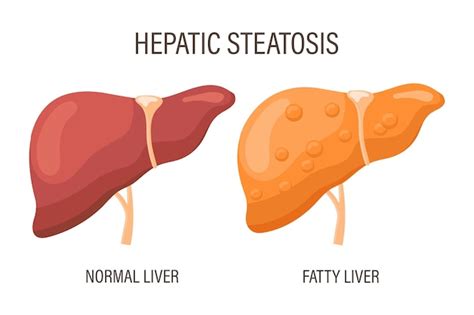 Steatosis Vectors And Illustrations For Free Download Freepik