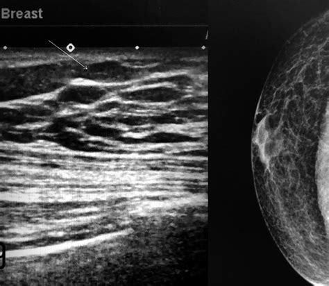 The Medical Enigma Of Rembrandts Bathsheba Journal Of Thrombosis And