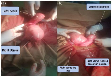 Didelphys Uterus Ultrasound