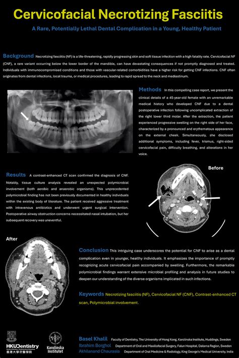 Pdf Cervicofacial Necrotizing Fasciitis A Rare Potentially Lethal Dental Complication In A