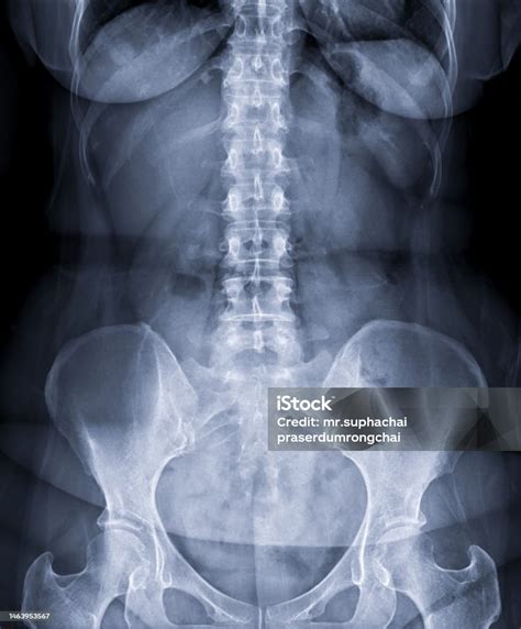 Imagen De Rayos X De La Columna Lumbar O La Vista Frontal De La Columna