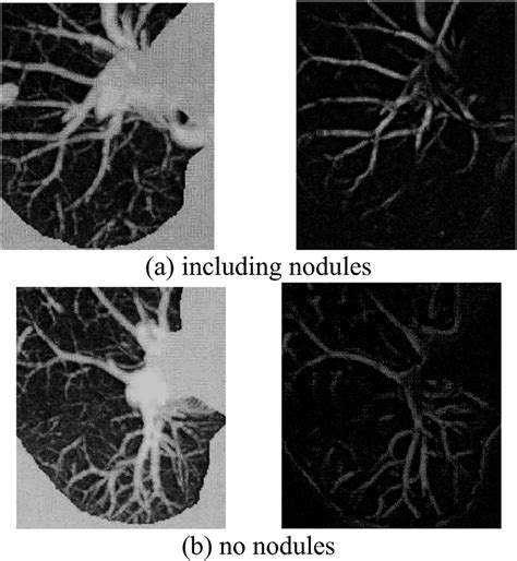 Pulmonary Threshold Segmentation Results Download Scientific Diagram