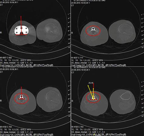 Measurement Of Rotation Of The Tibial Component With Computed Tomography Download Scientific