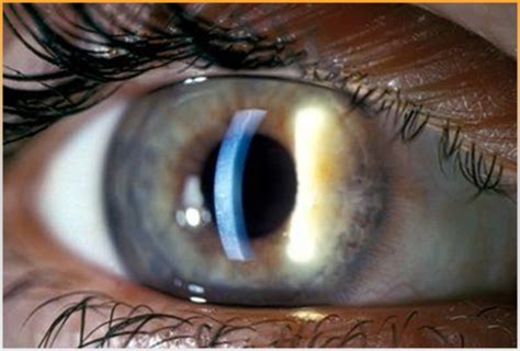 Slit Lamp 2 Parallelepiped Corneal And Lens Section Anterior Vitreous Flashcards Quizlet