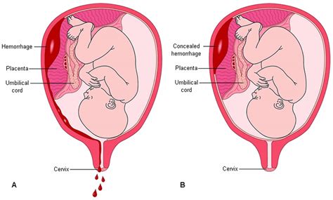Placental Abruption Causes Signs Symptoms Treatment