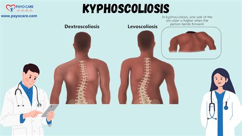 Kyphoscoliosis Causes Symptoms Prevention Diagnosis And Treatment