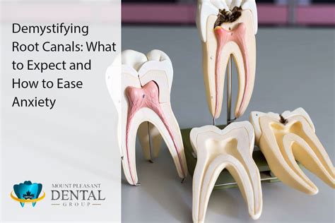 Demystifying Root Canals What To Expect And How To Ease Anxiety