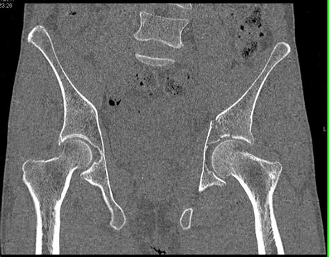 Acetabular Fracture With Automated Bone Removal Musculoskeletal Case