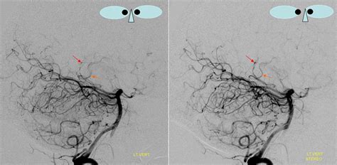 Posterior Choroidal Arteries