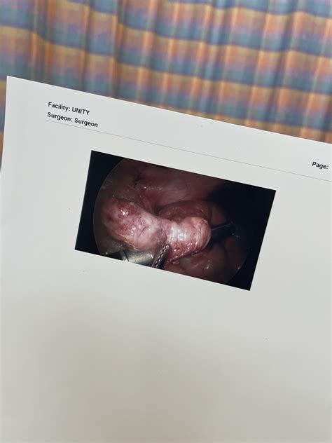 Got My Appendix Out And I Asked For A Picture R MedicalGore