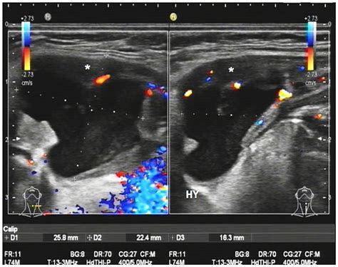 High Resolution Ultrasound Of Thyroglossal Cysts With Special Emphasis