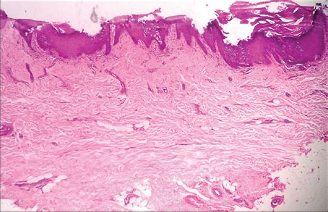 Unilateral Striate Punctate Keratoderma An Extremely Rare Presentation Of Punctate Keratoderma Unilateral Striate Punctate Keratoderma An Extremely Rare Presentation Of Punctate Keratoderma