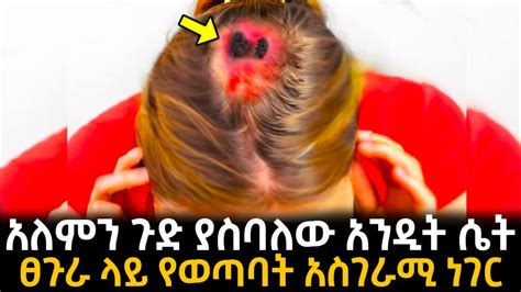 አለምን ጉድ ያስባለው አንዲት ሴት ፀጉራ ላይ የወጣባት አስገራሚ ነገር Youtube