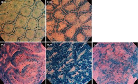Endoscopy Abnormal Cells