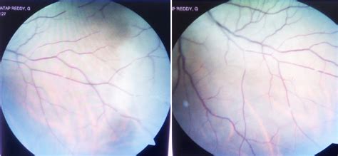 A B Fundoscopy Showing Retinal Opacification And Box Carring Download Scientific Diagram