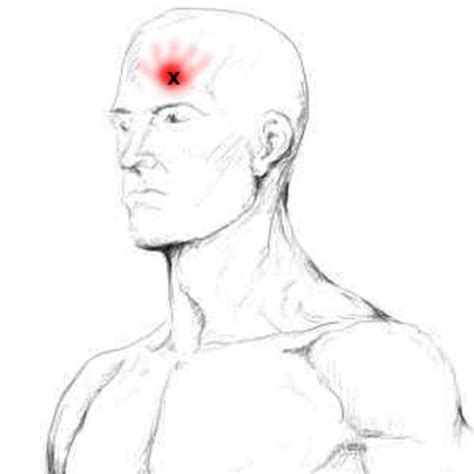 Frontalis And Occipitalis Pain Trigger Points
