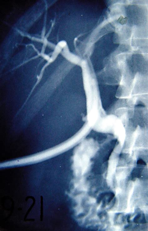 Biliary Stricture 1581 Bile Duct Stricture Pancreatitis 11 Surgery Photos