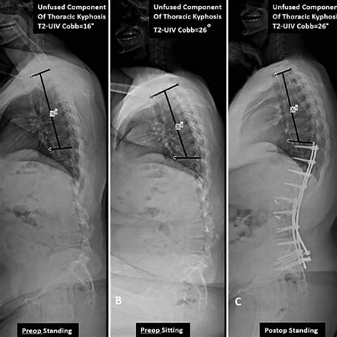The Four Types Of The Roussouly Sagittal Classification The Shape Of