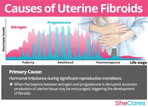 Causes Of Uterine Fibroids Hot Sex Picture