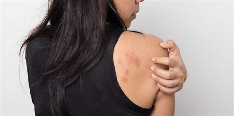 How To Recognize And Treat Stress Rashes And Hives According To