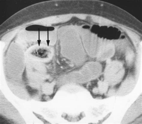 Gastrointestinal Bezoars Sonographic And Ct Characteristics Ajr