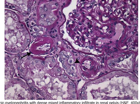 Figure 2 From Pyogenic Liver Abscess And Pulmonary Septic Emboli In A