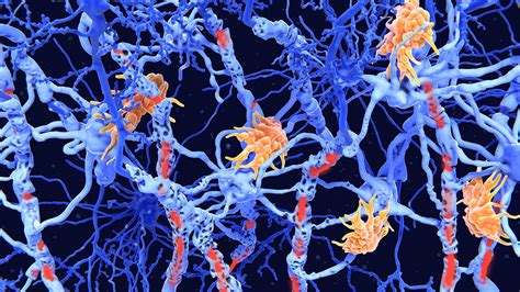 Ms Disease Severity Tied To Genetic Variant Medpage Today