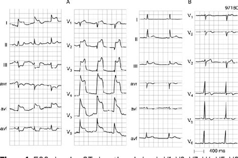 Table 1 From Frequency Of Incomplete St Segment Resolution After Successful Primary Percutaneous