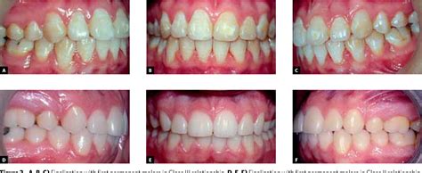Figure 3 From Asymmetric Extractions In Orthodontics Semantic Scholar