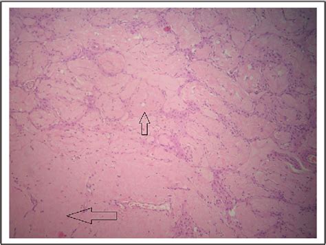 Figure 1 From A Case Of ‘burned Out Testicular Choriocarcinoma Presenting With Prostatic