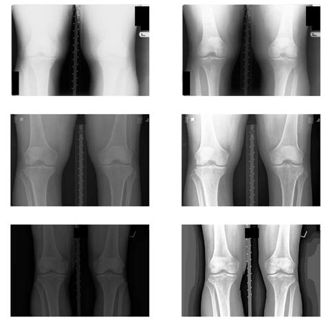 2 Samples Of X Ray Images Before Left And After Right Histogram