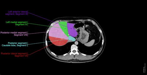 Pericardial Lymph Node