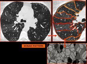 Tree In Bud On Ct Chest Gwenda Bachman