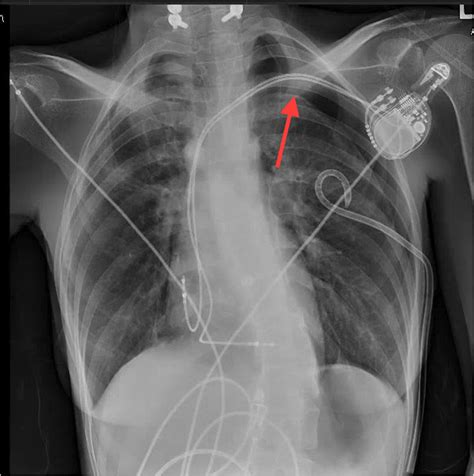 Image 1 Chest X Ray On Admission Refer To The Red Arrow Showing