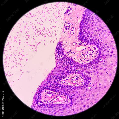 Stock Foto „buccal Mucosa Squamous Hyperplasia Show Hyperplastic Squamous Epithelium Photo