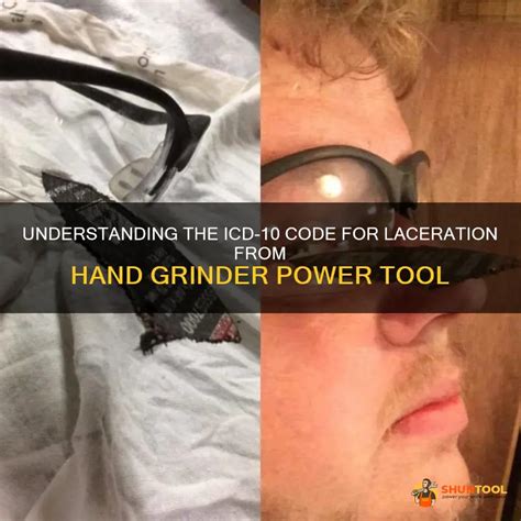 Understanding The Icd 10 Code For Laceration From Hand Grinder Power